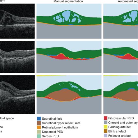Our proposed AI framework a Raw retinal OCT scan 6 6 2 3 mm³ Download Scientific Diagram