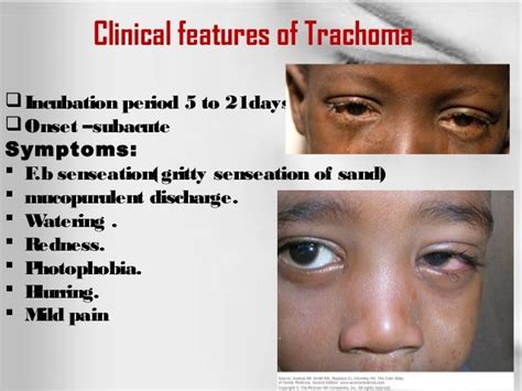 Chlamydia Conjunctivitis