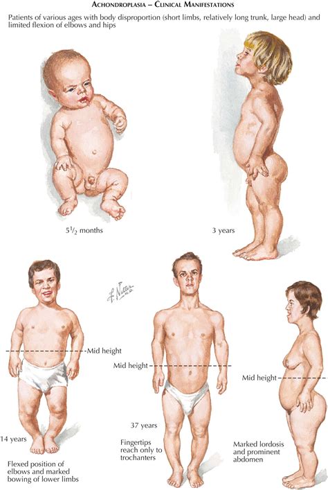 Achondroplasia Dwarfism Skeleton