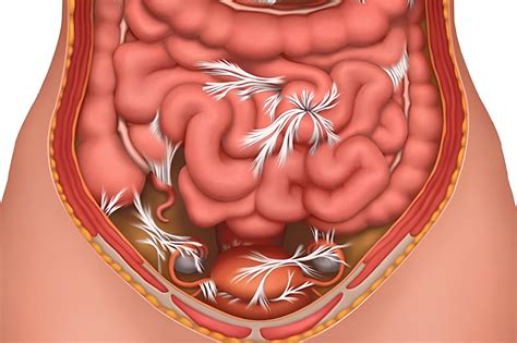 Intra Abdominal Adhesions Dr Sulaiman Yusof