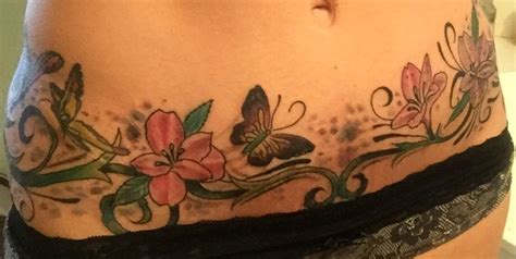 Pin On Tummy Tuck