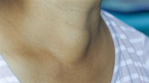 Hyperthyroidism Neck