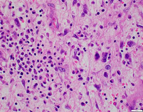Pathology Outlines Undifferentiated Embryonal Sarcoma