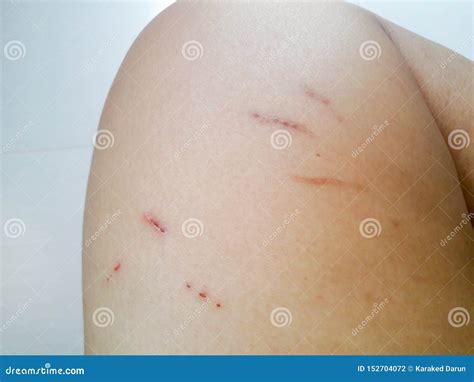 Scratch Marks On Skin