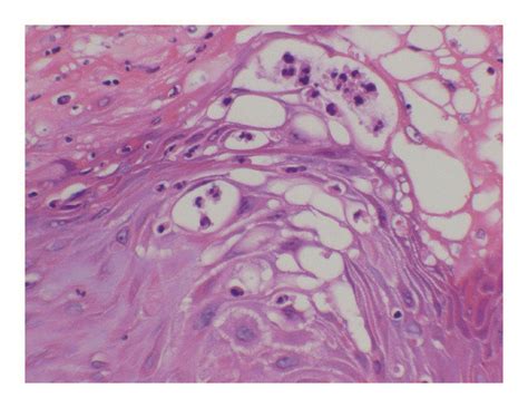 Intraepithelial Microabscesses Download Scientific Diagram