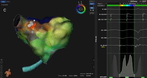 Electroanatomic Mapping Of The Left Atrium Performed With The Download Scientific Diagram