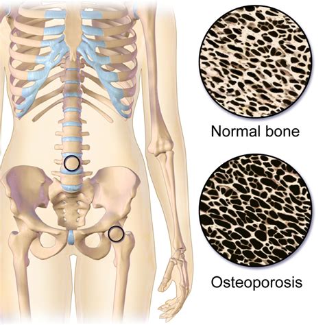 Bone Mineral Density Testing Bmd Womens Health By Dr Lee Say Fatt