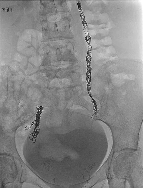 Unique Case Of Recurrent Pelvic Congestion Syndrome Treated With Median