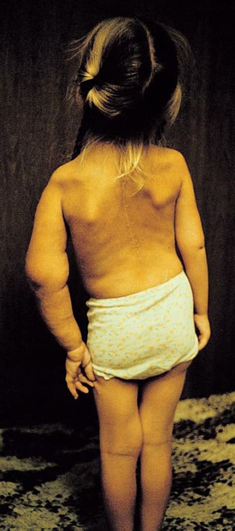 Image Neurofibromatosis Skeletal Anomalies Msd Manual Professional Edition