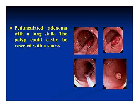 Colonic Polyposis Pdf