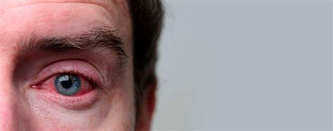 ¿qué Es La Blefaritis Clínica Oftalmológica Confía La Mejor Clínica