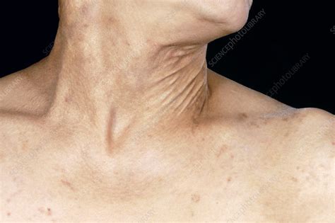 Pseudoxanthoma Elasticum Stock Image C021 2775 Science Photo Library