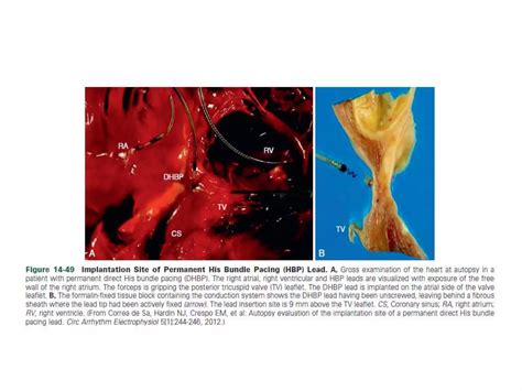 His Bundle Pacing Pptx