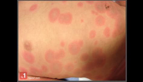 Erythema Marginatum Vs Erythema Multiforme
