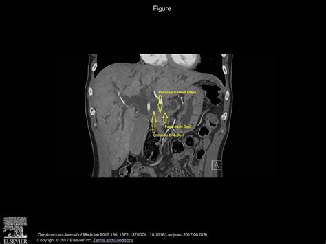 The Hyperlipidemia Effect Pseudohyponatremia In Pancreatic Cancer