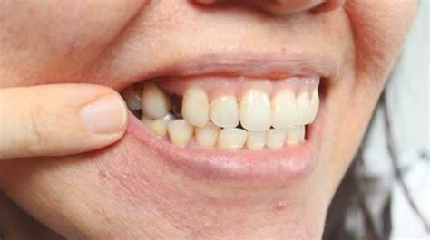 Effects Of Not Replacing Missing Teeth Missing Teeth Consequences