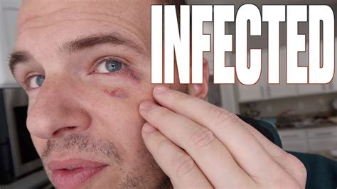 What Do Infected Stitches Look Like Pfplcp
