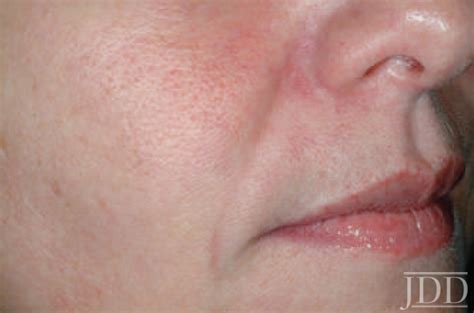 Vascular Complications Of Fillers Treatment Pearls For Impending