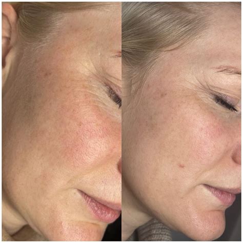 Fractional Co2 Skin Rejuvenation The Norwich Face And Body Clinic