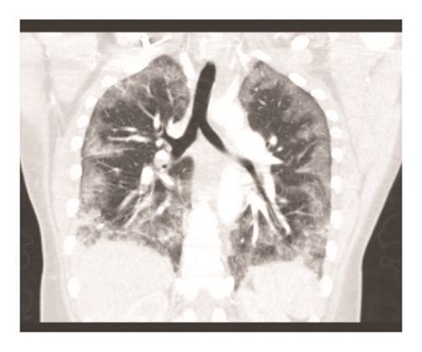 A Chest X Ray Pa View Shows Increase Attenuated Over Peripheral Lung