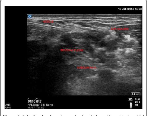 Figure 1 From Ultrasound Guided Phrenic Nerve Block For Intractable Hiccups In Patients