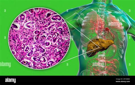 Liver Cirrhosis Computer Illustration And Light Micrograph Of A Section Through A Human Liver