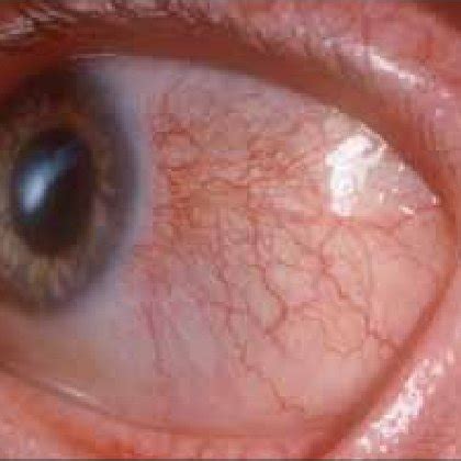 A Diffuse And B Nodular Anterior Scleritis The Eye Is Beefy Red Download Scientific