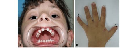 Female Carrier Of X Linked Hypohidrotic Ectodermal Dysplasia Female Download Scientific