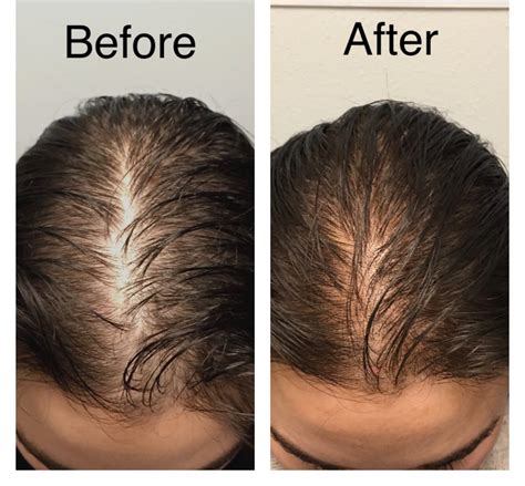 Scalp Micropigmentation Results • About Face And Body Scalp Micropigmentation Results • About Face And Body