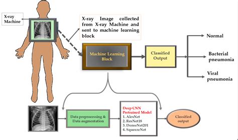 Pneumonia Disease Detection Using Machine Learning” By Abdelrahman Wael Ammar Medium