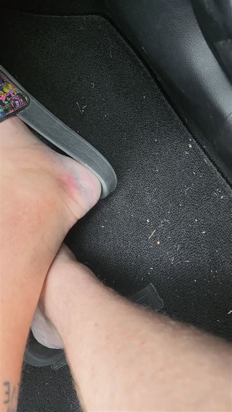 Acl Reconstruction Meniscus Removal Meniscectomy R Acl