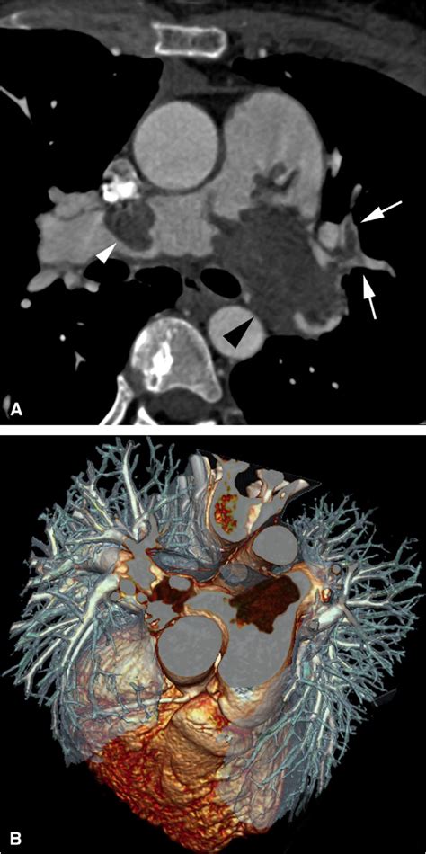 Figure 1 From Primary Intimal Pulmonary Artery Sarcoma A Diagnostic