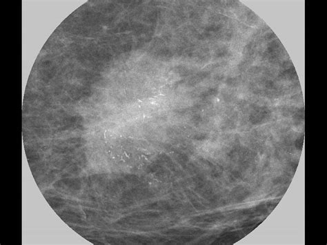 Atlas Of Breast Cancer Early Detection