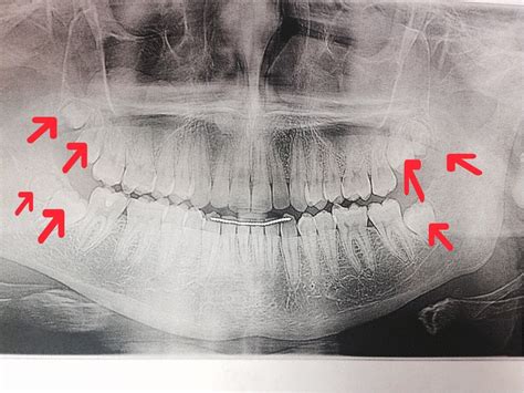 So Today I Learned That I Have 7 Wisdom Teeth Mildlyinteresting