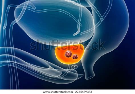 Prostate Cancer Organs Tumor Cancerous Cells Stock Illustration 2264439383 Shutterstock