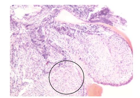 Multisystemic Sarcoidosis Presenting With Leg Ulcers Pancytopenia And