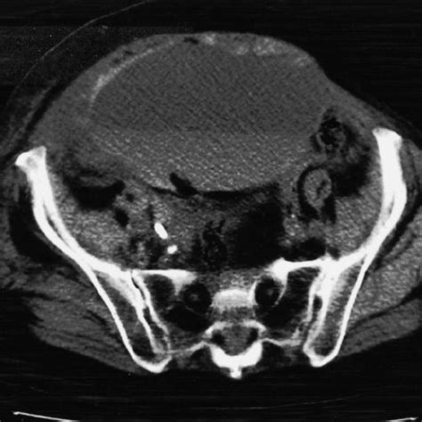 Abdominal Ct Scan Shows Retrocecal Appendix Enlargement Of Over 6 Mm In