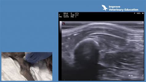 Ultrasound Guided Rumm Block Part 1 Musculocutaneous Median And