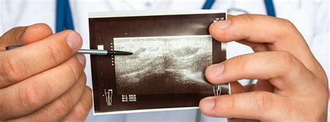 ¿qué Es El Quiste Pilonidal O Sacro Y Cómo Se Trata Canalsalud