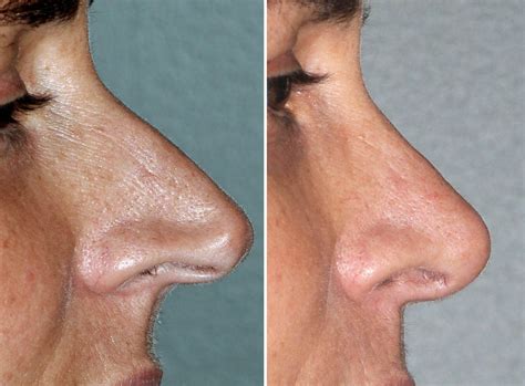 Pinocchio Nose