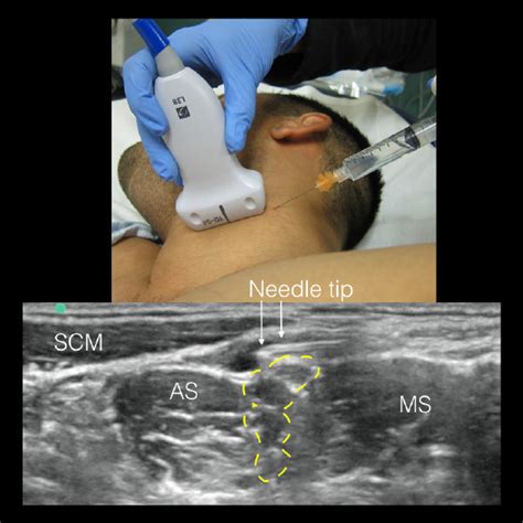 How To Implement Ultrasound Guided Nerve Blocks In Your Ed Acep Now How To Implement Ultrasound Guided Nerve Blocks In Your Ed Acep Now
