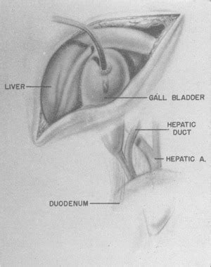 Utilization Of Cholangiogram During Exploration For Biliary Atresia NEJM