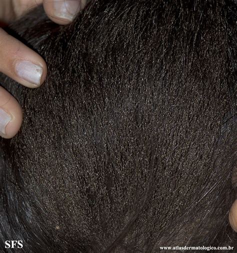 Pediculosis Capitis Nc Commons