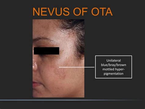 Overview Of Hyperpigmentation Disorders Pptx Skin And Dermatology