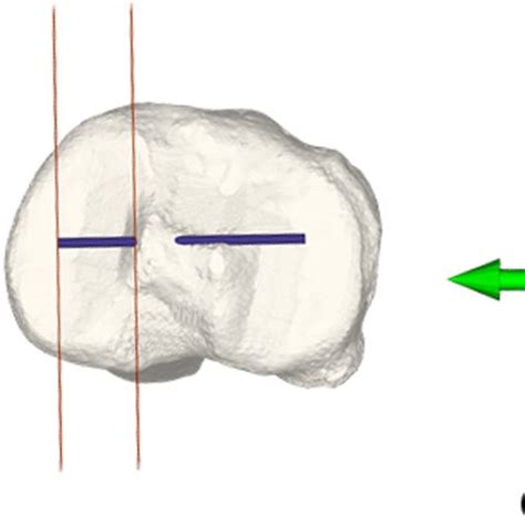 Axial Center Of Rotation And Simulation Of Tibial Internal Rotation Download Scientific