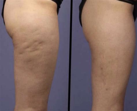 Ultrasonic Cavitation Machine Before And After Results Slim Sonic Tech