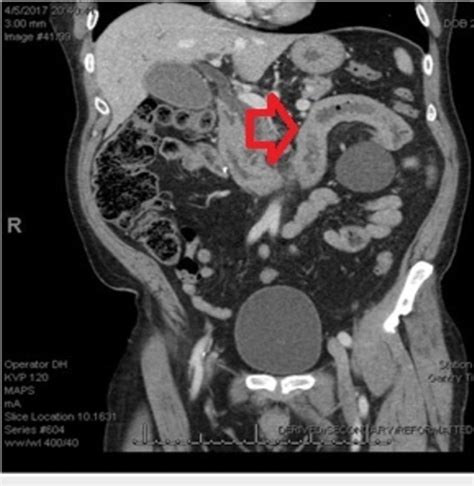 Ct Abdomen Pelvis Showing Thickening Of The Duodenum And Proximal Small Download Scientific