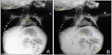 A B X Ray Shunt Series Showing VP Shunt Tubing Marked By Yellow Arrows Download Scientific