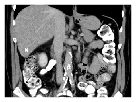 Abdominal Ct Scan Showing Diffuse Calcifications Of The Infrarenal Download Scientific Diagram