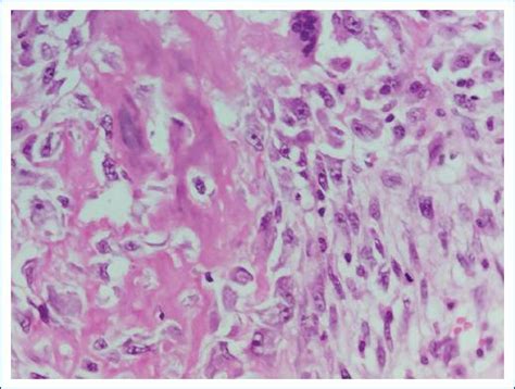 Osteosarcoma Histology